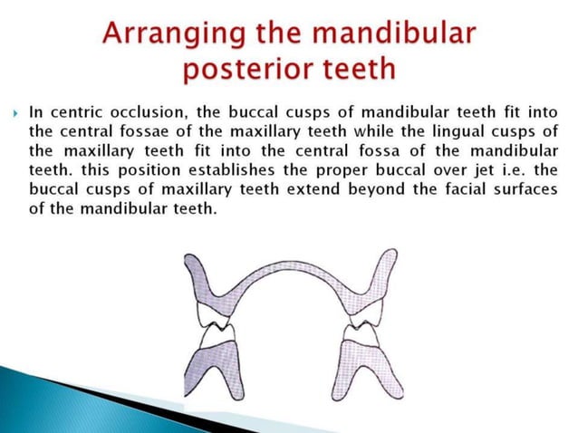 Setting maxillary posterior anatomic denture teeth cd 2nd yr | PPTX ...