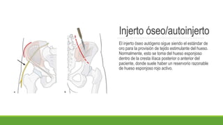 Seudoartrosis aseptica en fracturas de tibia | PPTX