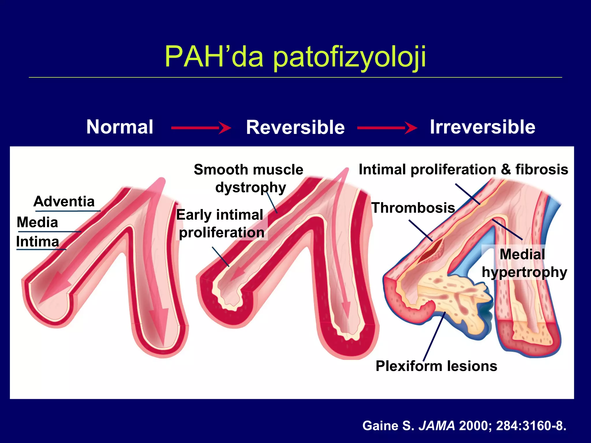 pah | PPT