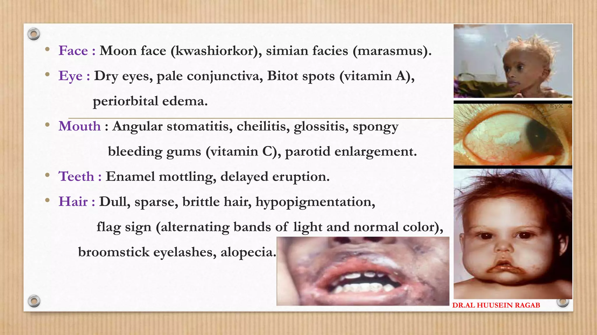 Severe acute malnutrition | PPTX