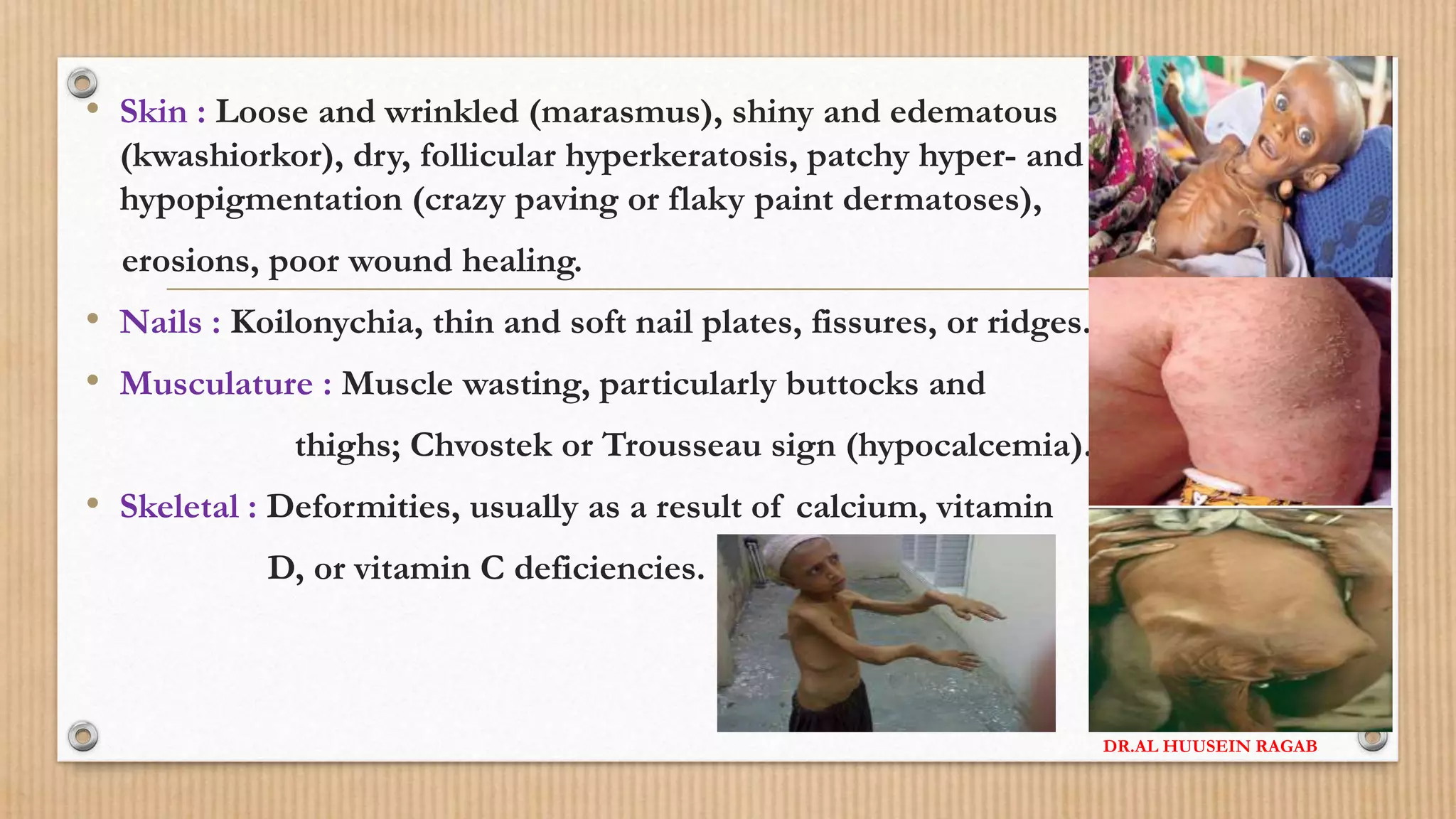 Severe acute malnutrition | PPTX