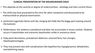 Severe acute malnutrition by efe obasohan | PPTX