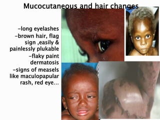 Severe acute malnutrition lecture presentation by habtamu | PPT
