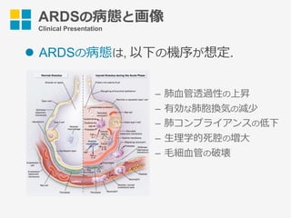 Severe ARDSの初期治療 | PDF