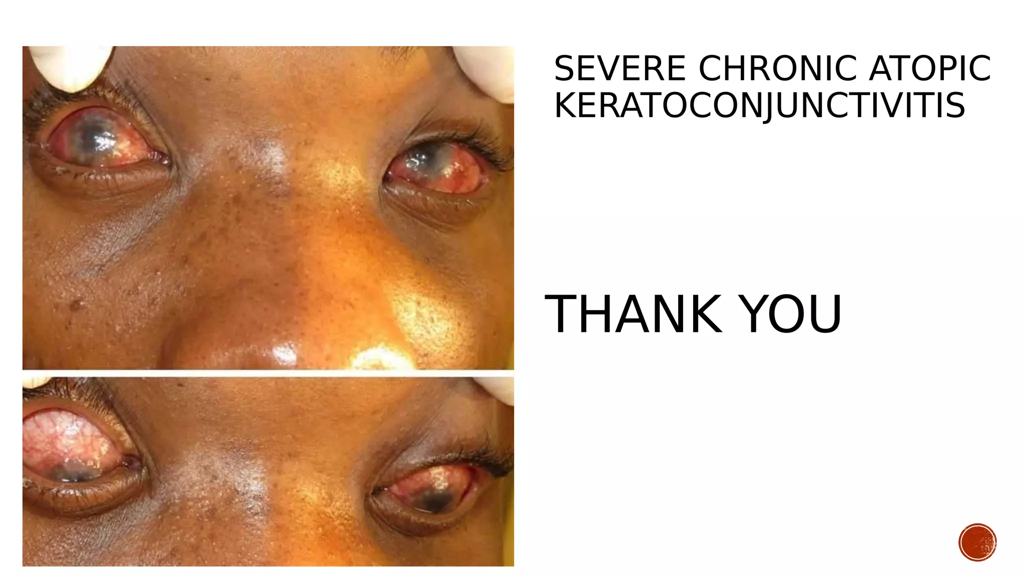 Severe chronic atopic keratoconjunctivitisSevere chronic atopic ...