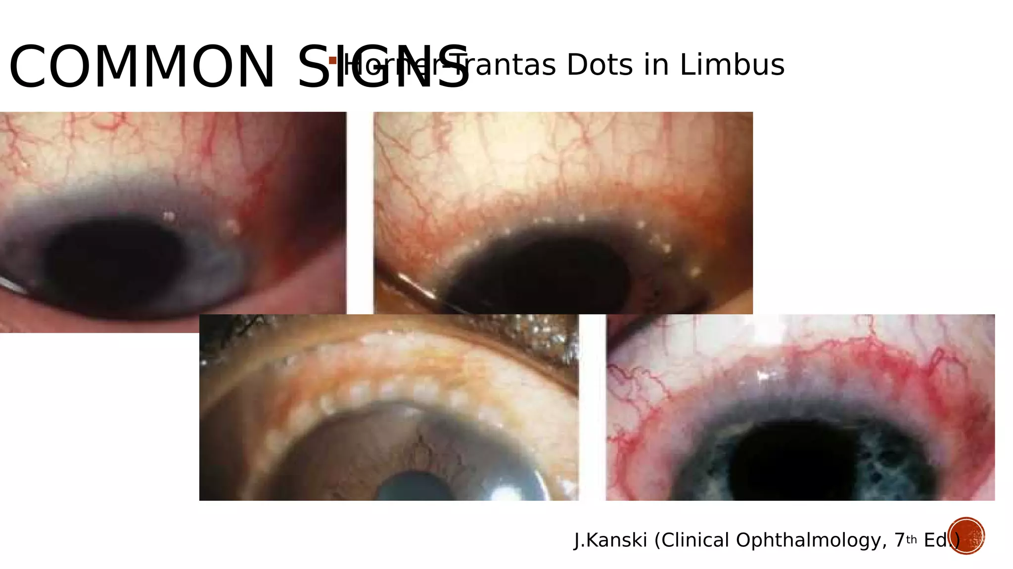 Severe chronic atopic keratoconjunctivitisSevere chronic atopic ...