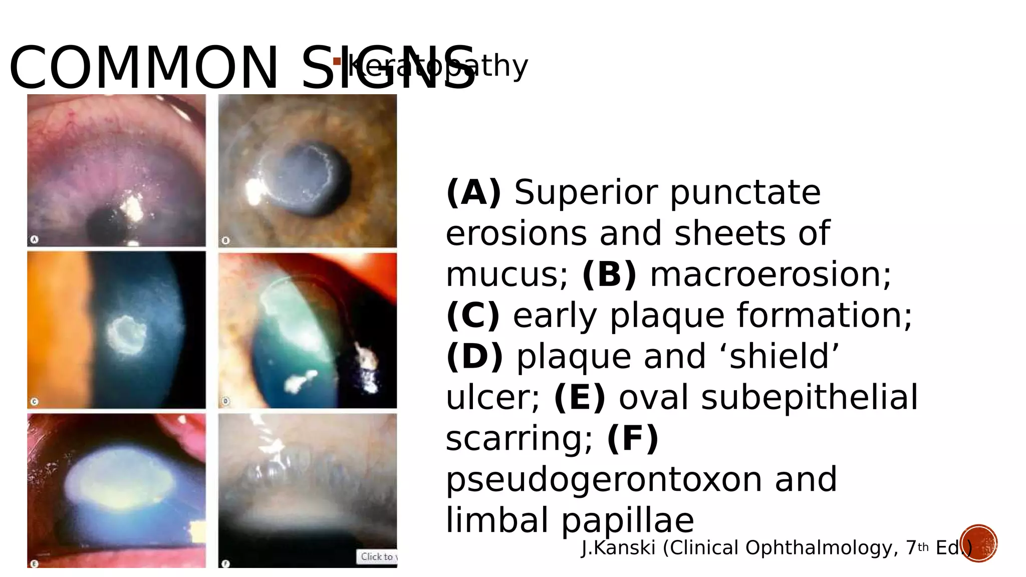 Severe chronic atopic keratoconjunctivitisSevere chronic atopic ...