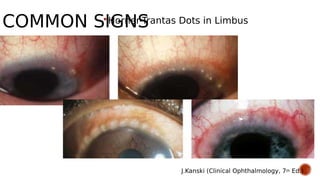 Severe chronic atopic keratoconjunctivitisSevere chronic atopic ...
