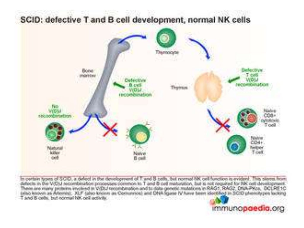 Severe combined immunodeficiency