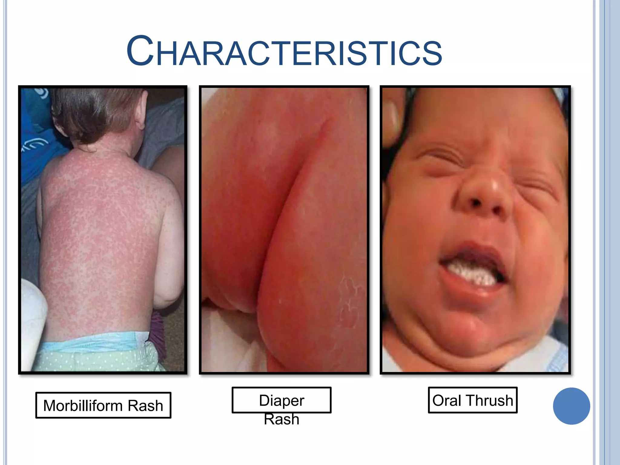 Severe combined immunodeficiency (scid) | PPTX