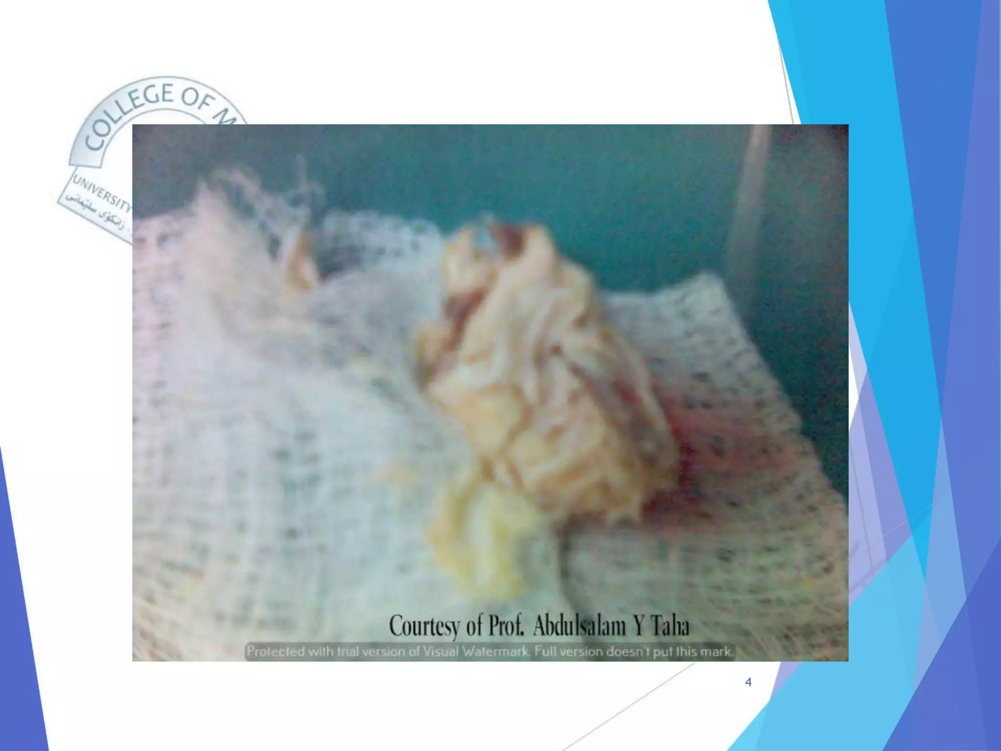 Severe Dysphagia due to Food Bolus Impaction in a Young Man.pdf