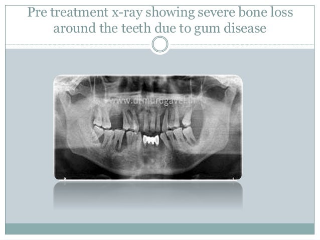 Severe periodontal bone loss treatment with full jaw dental implants