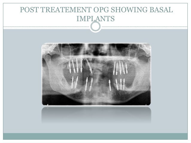 Severe periodontal bone loss treatment with full jaw dental implants
