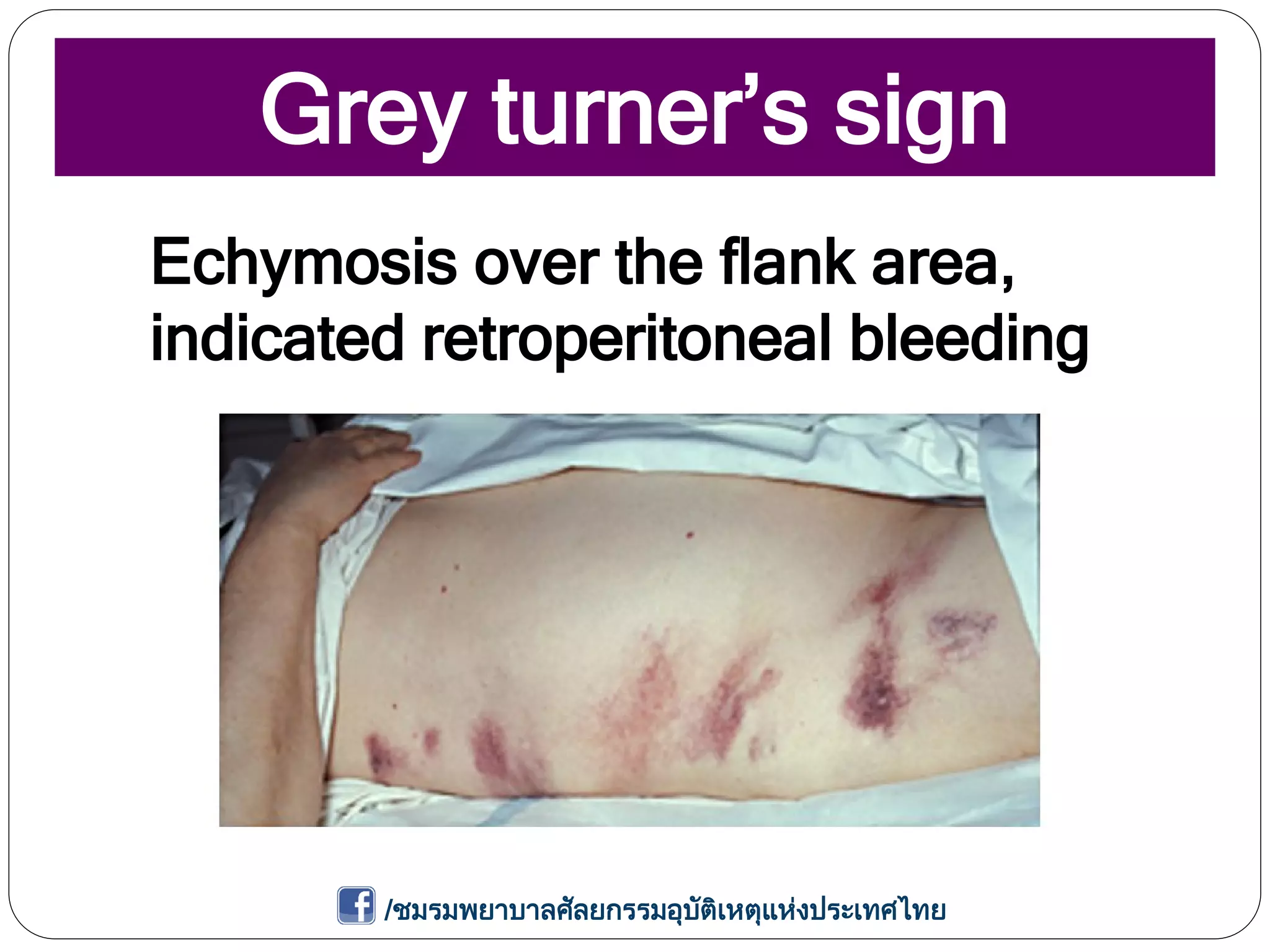 Severe trauma and traumatic shock 14 พค.58