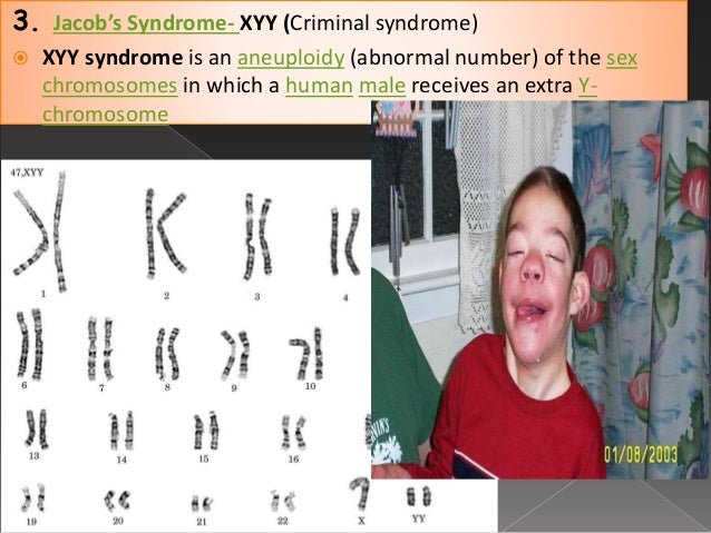Xyy Syndrome And Crime Pregnant Health Tips