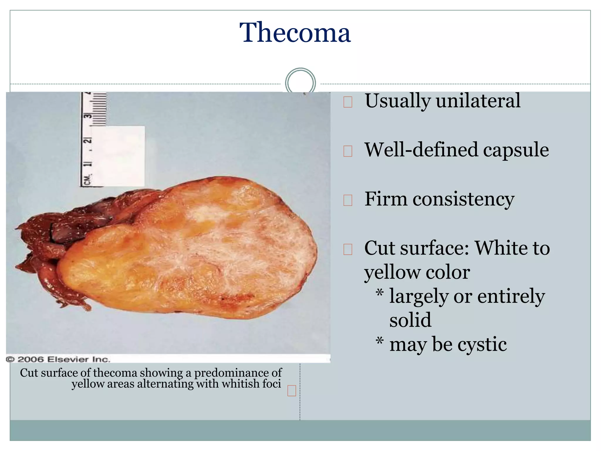 Sex cord stromal tumors- PATHOLOGY | PPTX