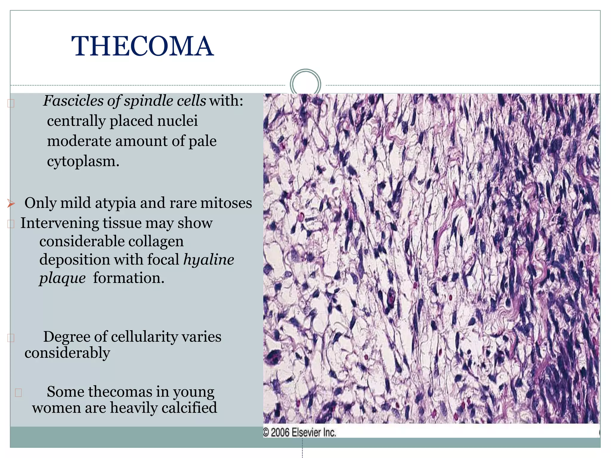 Sex Cord Stromal Tumors Pathology Ppt