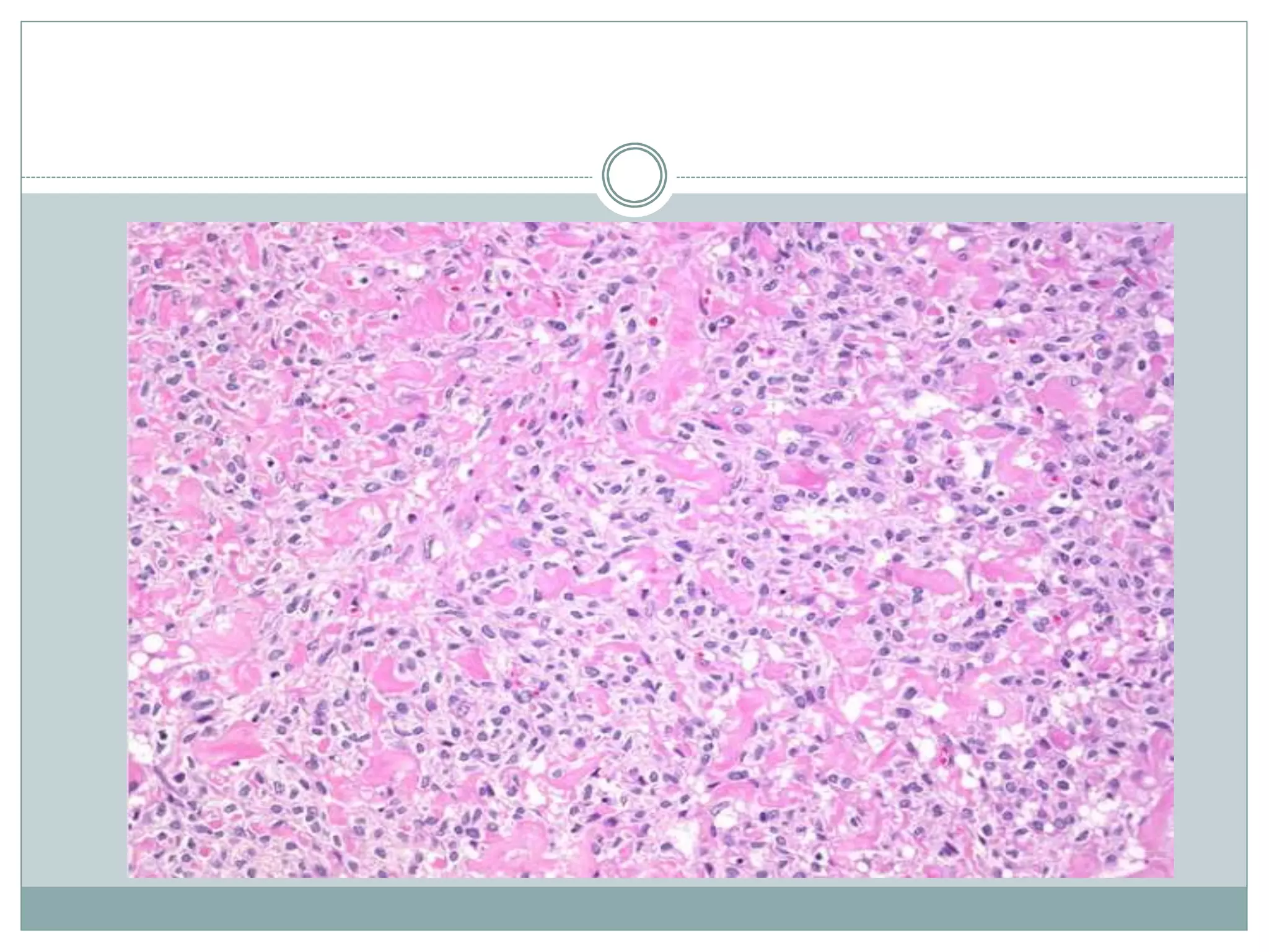 Sex Cord Stromal Tumors Pathology Ppt
