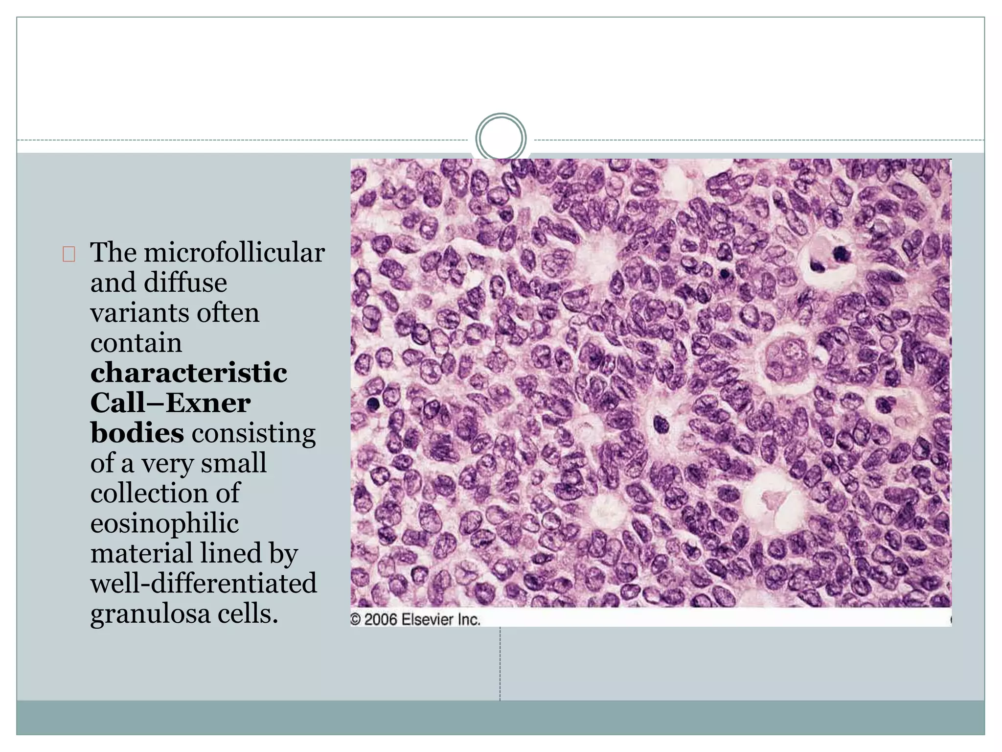 Sex cord stromal tumors- PATHOLOGY | PPTX