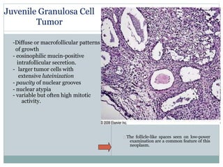 Sex cord stromal tumors- PATHOLOGY | PPTX