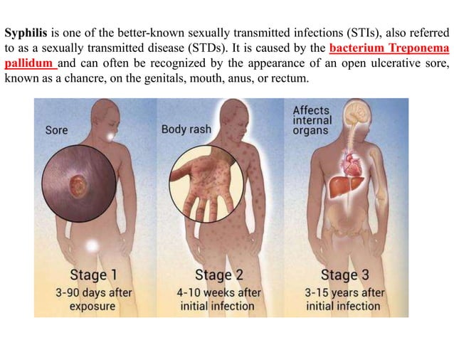 Sexually Transmitted Disease Syphilis Ppt