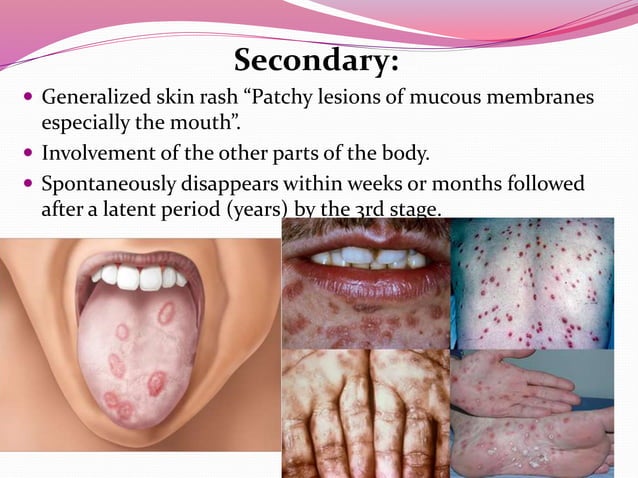 Sexually Transmitted Diseases Stds