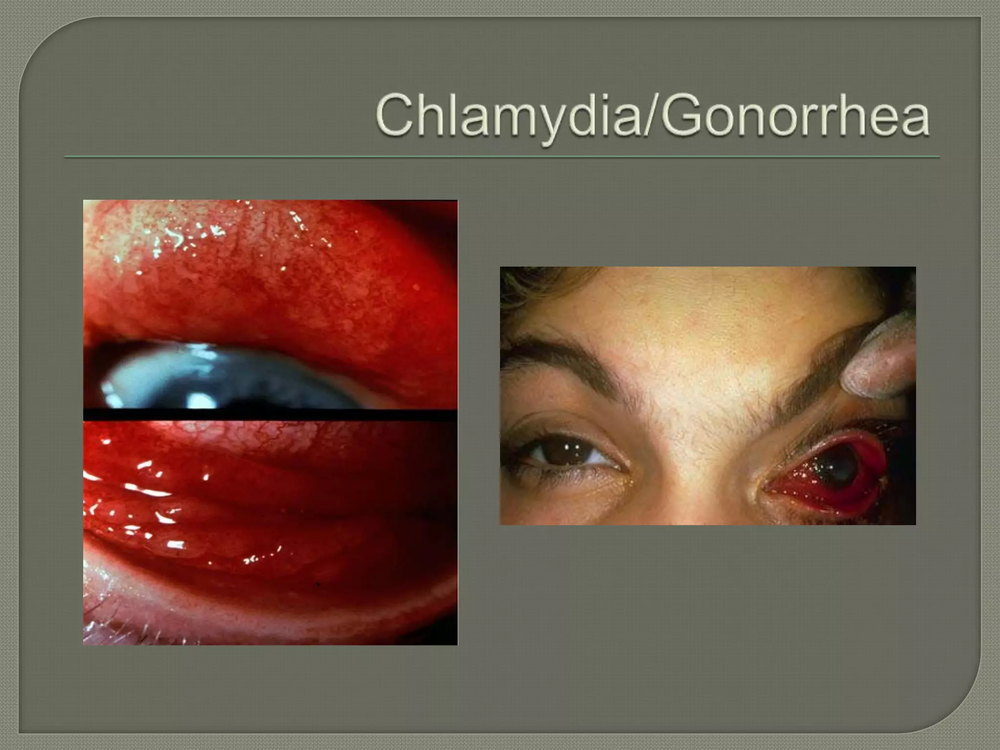 Sexually transmitted infection (sti) | PPTX