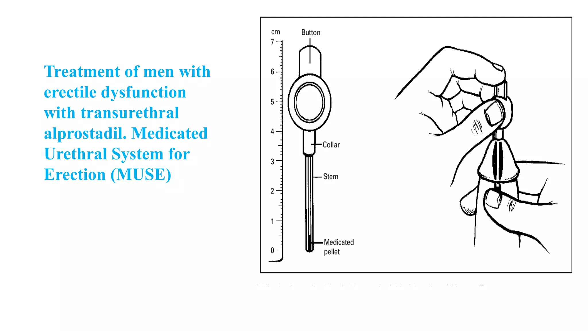 Sexual rehabilitation | PPTX