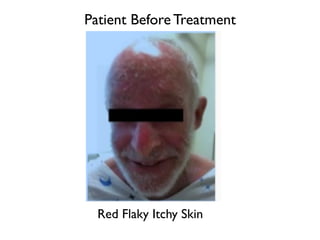 Sezary syndrome slides | PDF