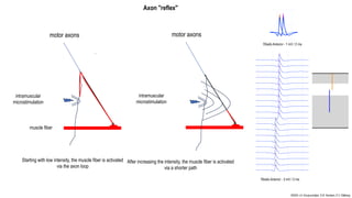 SFEMG Signal Atlas - Highlights - Stimulated - Pitfalls - VRF - Axon ...