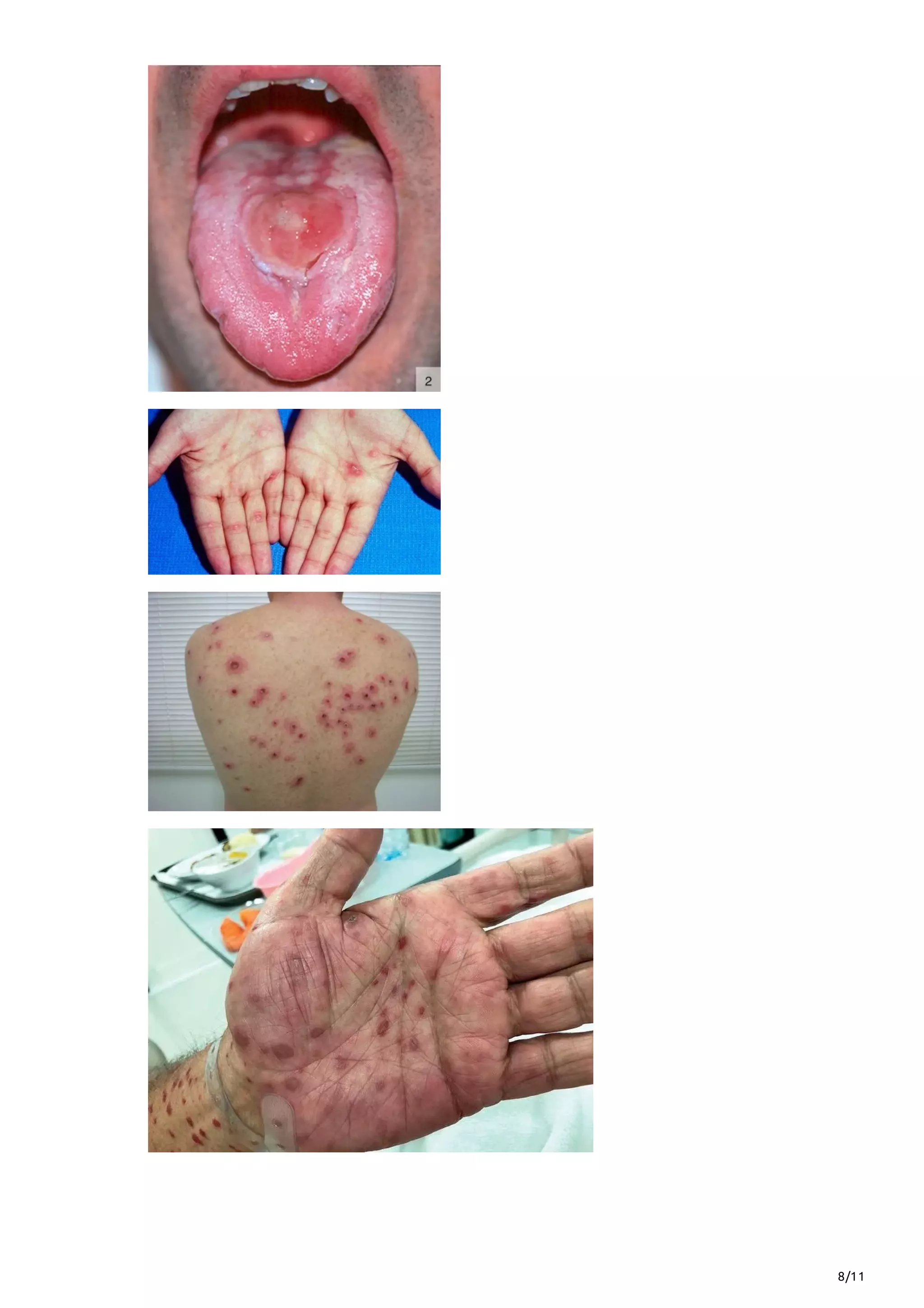 Ce este sifilisul si cum se trateaza | sfatulmedical.ro