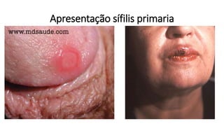 Sífilis Pptx