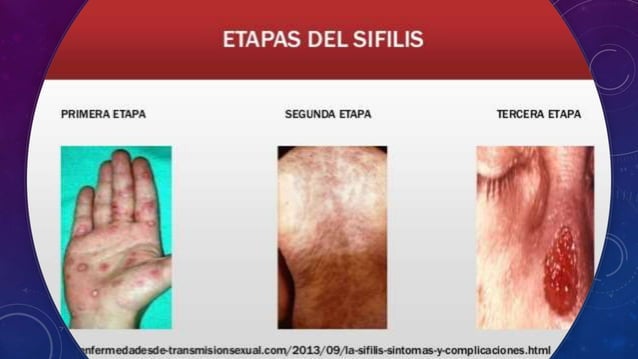 Sífilis: exposición de biología nivel de secundaria.pptx