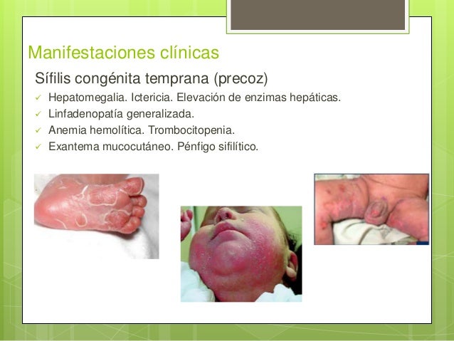 Sífilis congénita expo