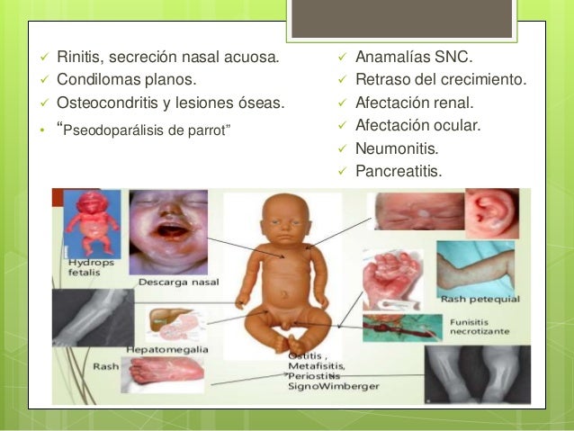 Sífilis congénita expo