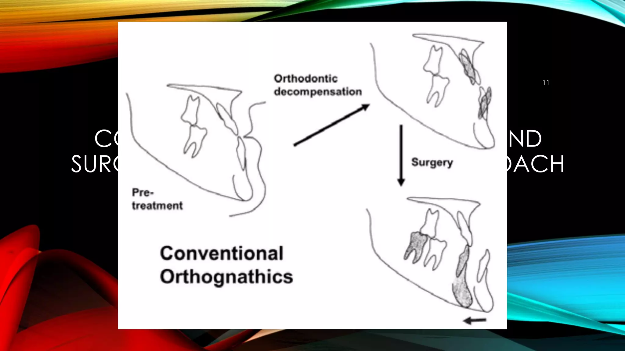 Surgery First Orthognathic Approach (SFOA) | PDF