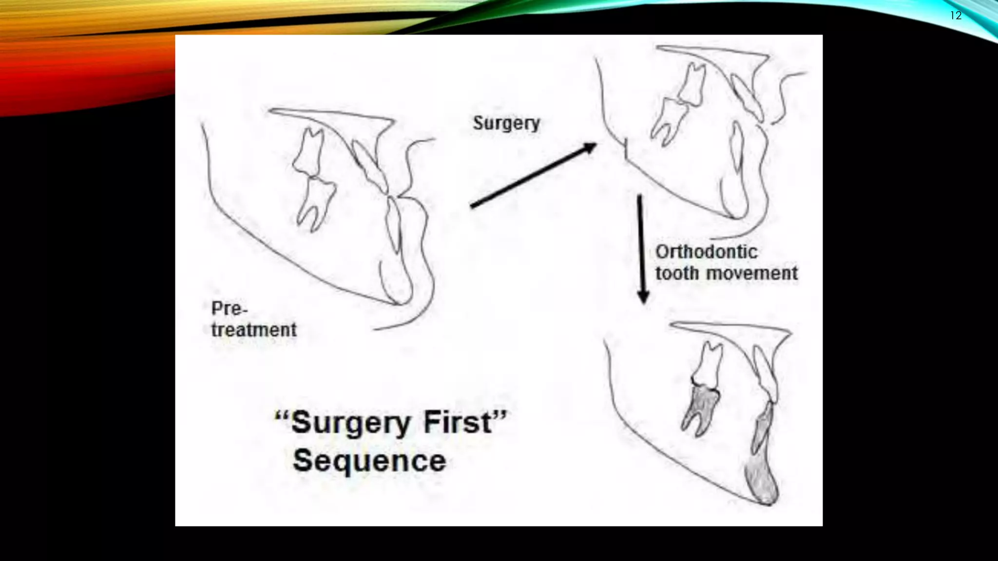 Surgery First Orthognathic Approach (SFOA) | PDF