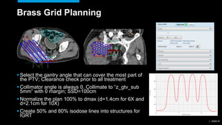 SG-SFRT The use of surface imaging for spatially fractionated ...