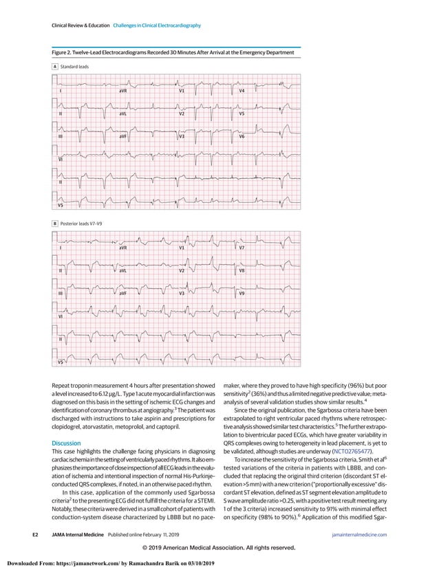 Sgarbossa criteria for the diagnosis of st elevation myocardial infarction