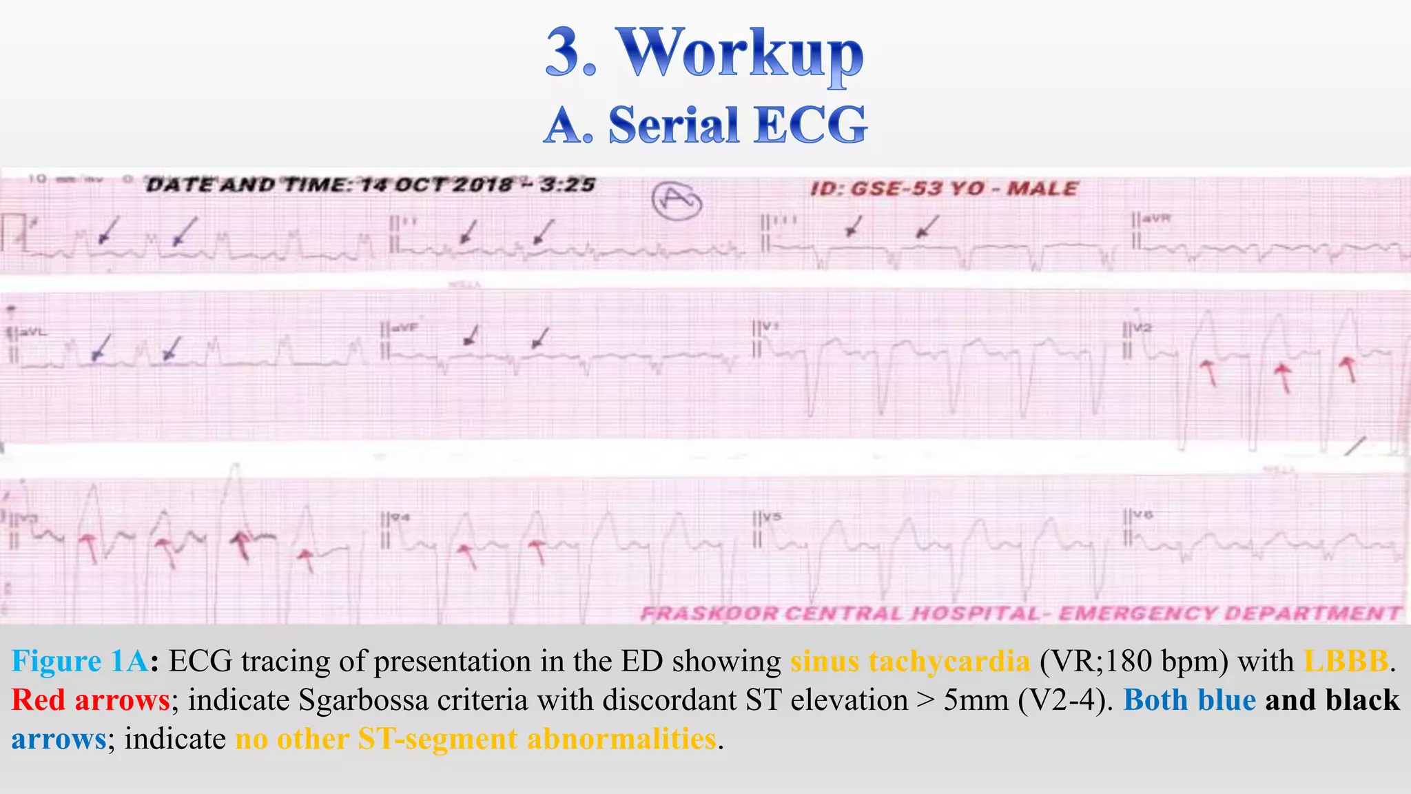 Sgarbossa Criteria in Left Bundle Branch Block in a Hypertensive ...