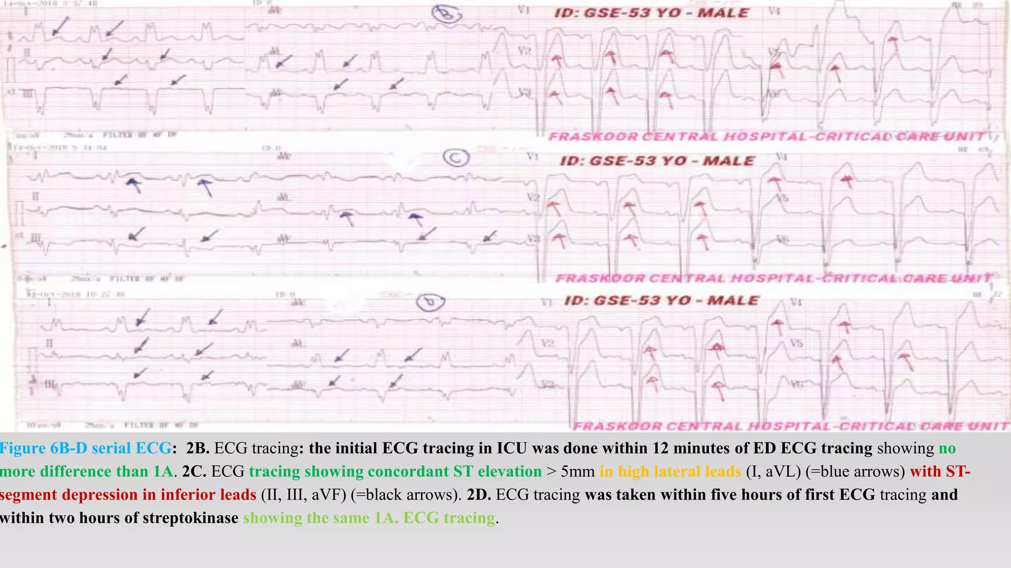 Sgarbossa Criteria in Left Bundle Branch Block in a Hypertensive ...