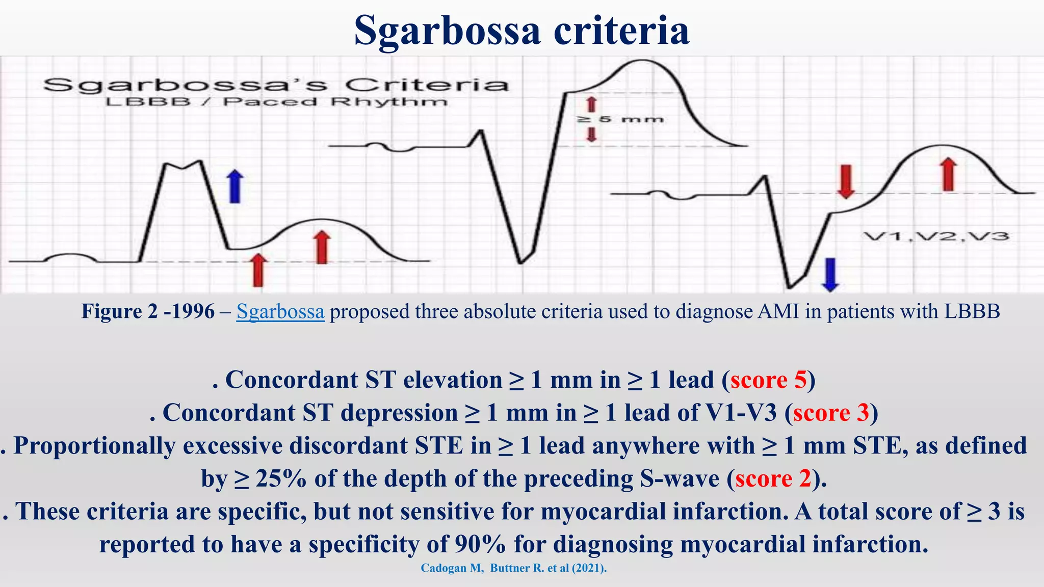 Sgarbossa Criteria in Left Bundle Branch Block in a Hypertensive ...