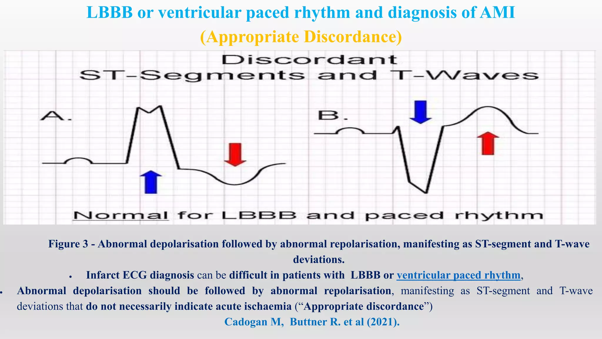 Sgarbossa Criteria in Left Bundle Branch Block in a Hypertensive ...