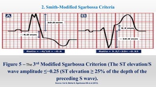 Sgarbossa Criteria in Left Bundle Branch Block in a Hypertensive ...