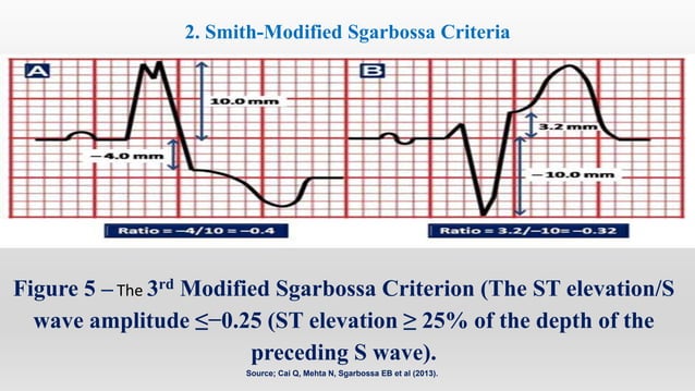 Sgarbossa Criteria in Left Bundle Branch Block in a Hypertensive ...