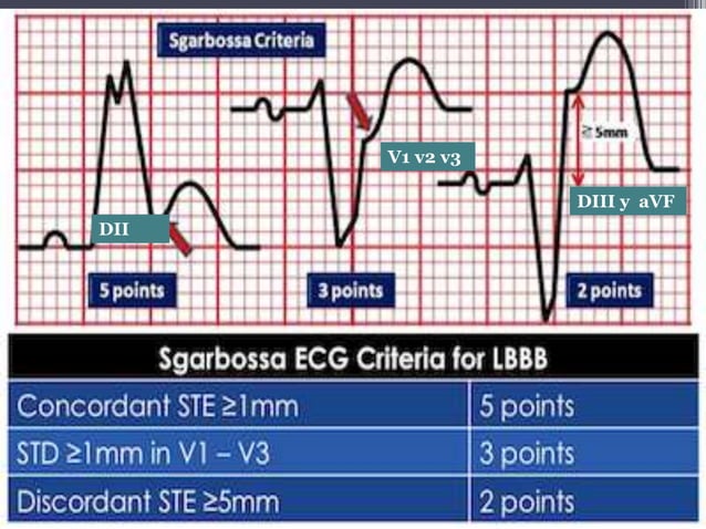 Sgarbossa criterios diagnosticos y ekg Guia rapida | PPTX