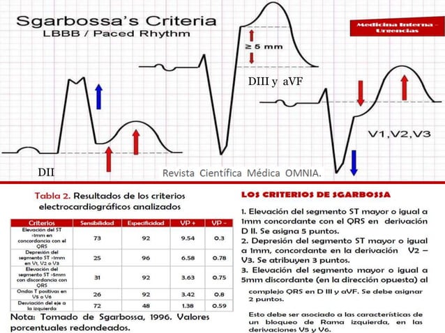 Sgarbossa Criterios Diagnosticos Y Ekg Guia Rapida