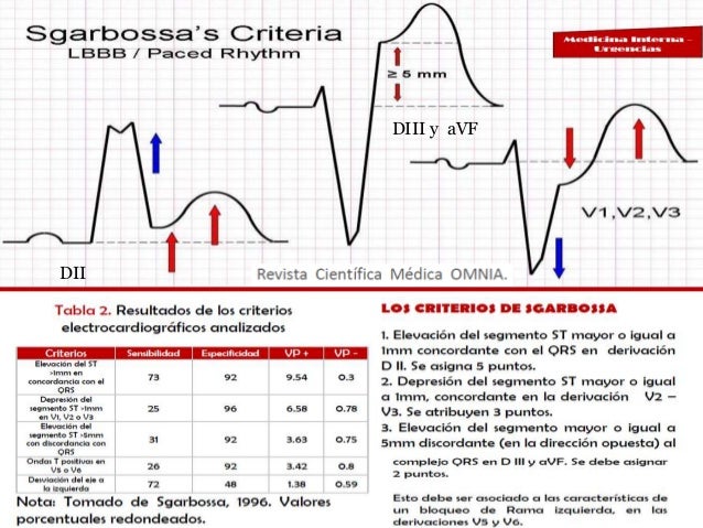 Sgarbossa criterios diagnosticos y ekg Guia rapida