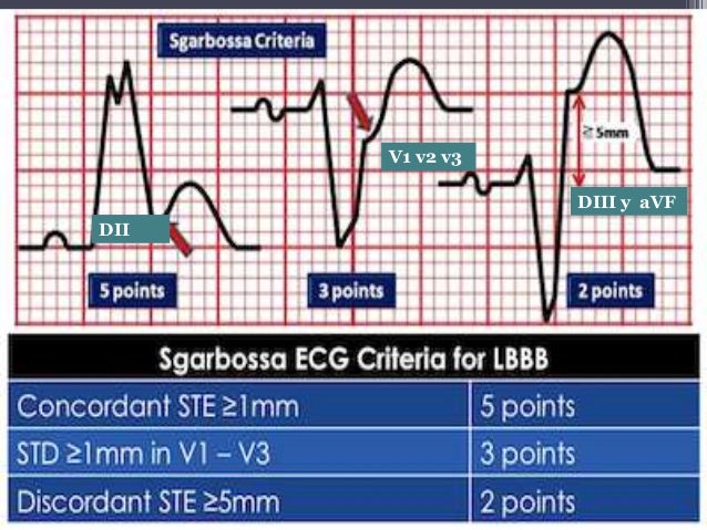 Sgarbossa criterios diagnosticos y ekg Guia rapida
