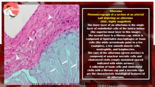 ATHEROSCLEROSIS presentation Pr medicals | PPTX